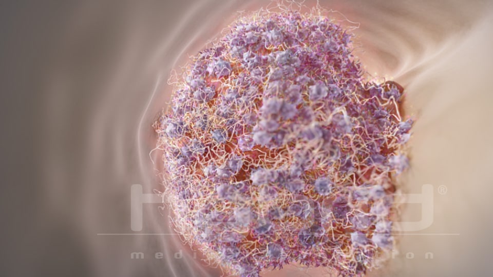 Thrombus - Hybrid Medical Animation