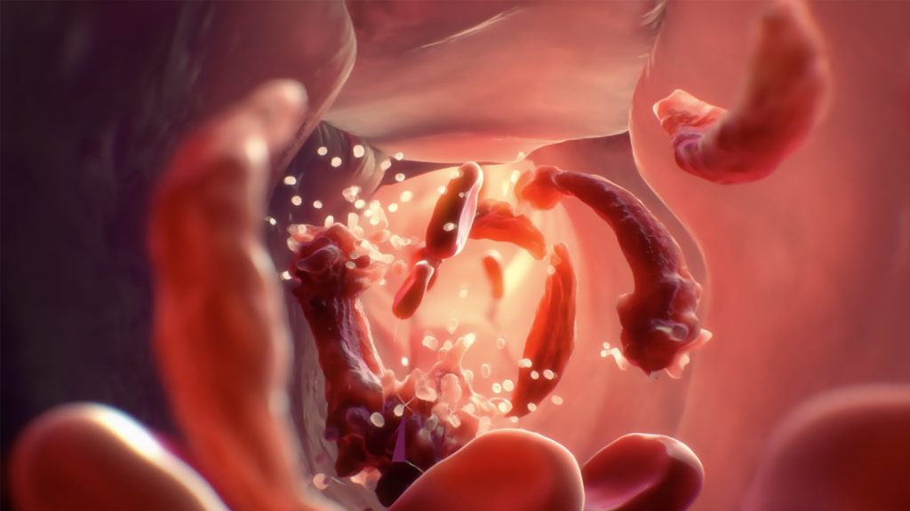 Sickle Cells | Hybrid Medical Animation